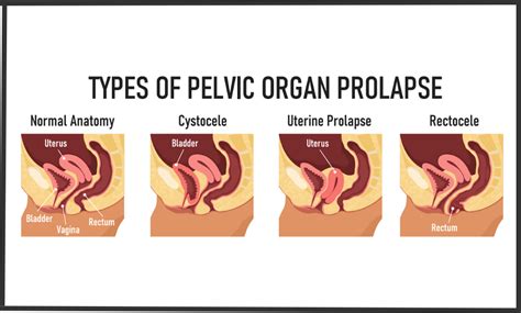 Uterine Prolapse Causes Risk Factors Symptoms Treatment