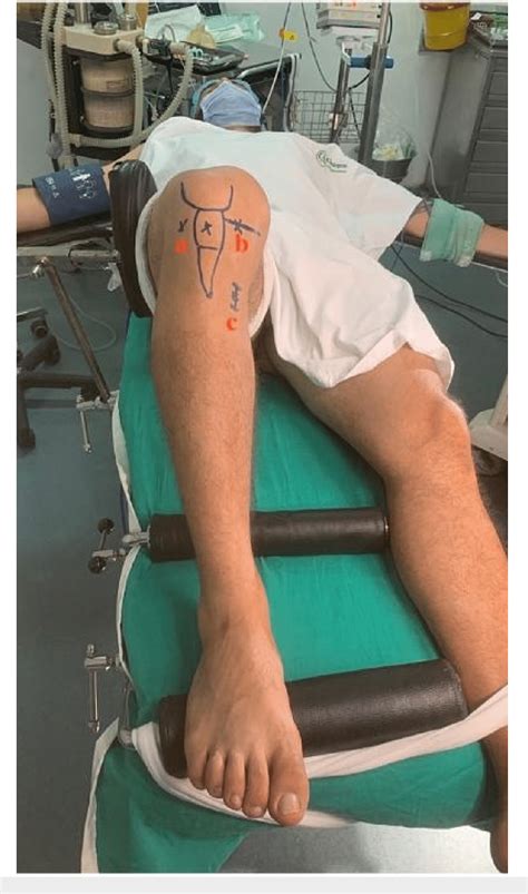 Figure 2 From Anterior Cruciate Ligament Arthroscopic Ligamentoplasty