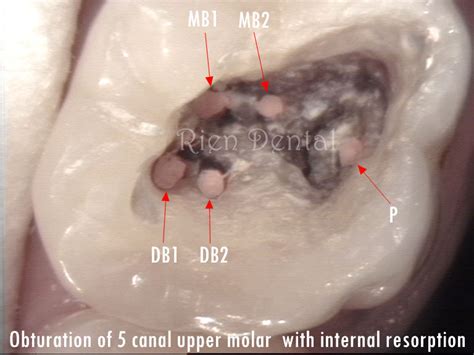 Internal Tooth Resorption Root Canal Treatment With 5 Canals