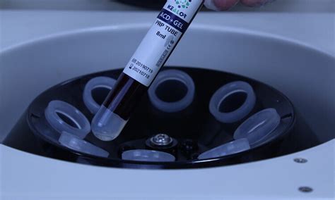 Prp Preparation Procedure Prp Kit Prp Tube Platelet Rich Plasma