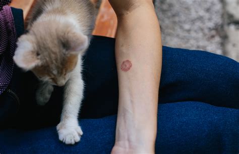 Ringorm Och Hårbottensvamp Symtom Och Behandling Meds Apotek