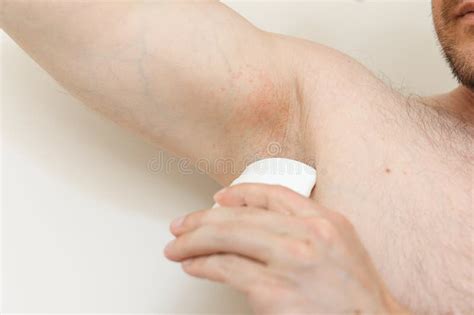 Joven Con Irritación Inflamación En La Piel Sensible De Las Axilas
