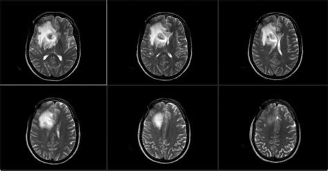 Admission Mri Head Demonstrating A Ring Enhancing Lesion And Ventriculitis Download