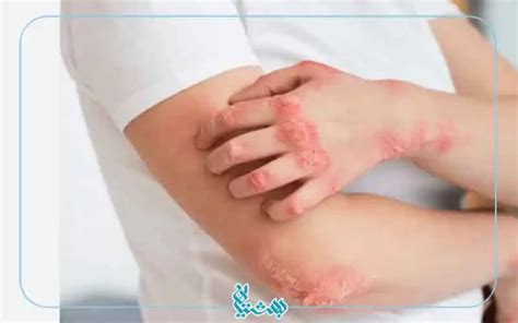 هر آنچه باید در مورد بیماری پسوریازیس بدانید کلینیک سلامتی
