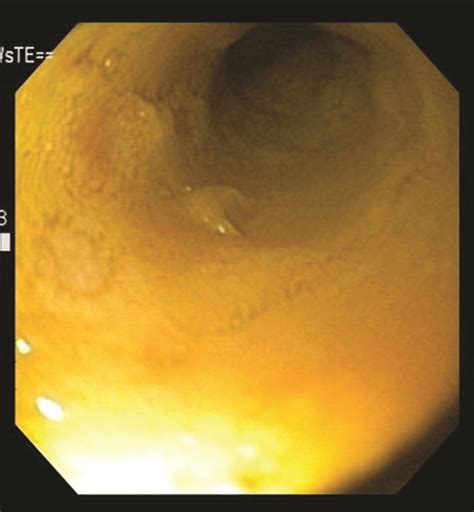 The Diabetic Cat With Inflammatory Bowel Disease Todays Veterinary