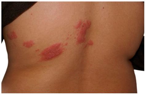 Varicella Zoster Virus Infection And Pregnancy An Optimal Management