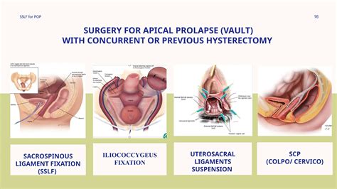 Sacrospinous Ligament Fixation For Pelvic Organ Prolapse Latest