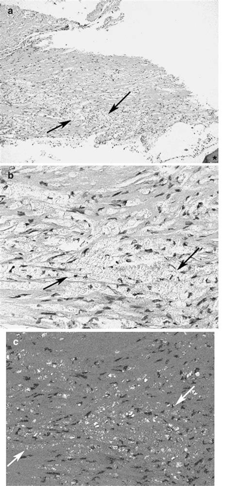 Photomicrographs Showing A Fibrous Membrane With An Infiltrate Of