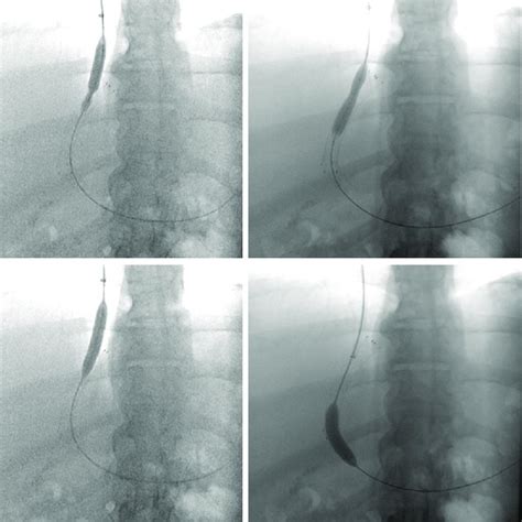 A Fluoroscopy Spot Image Shows New Stent Deployed Through Lateral