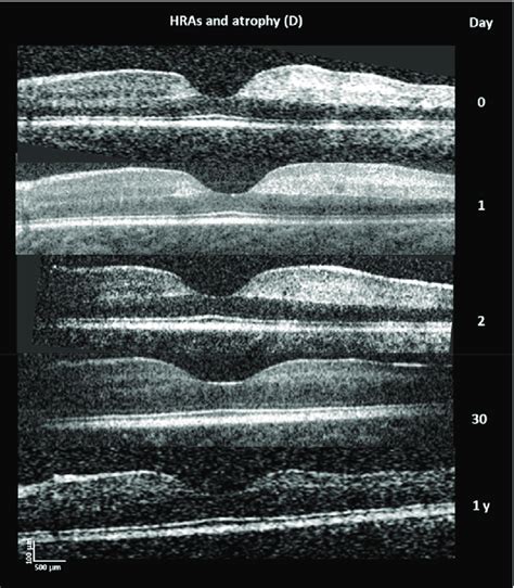Macular Oct Scans Of 22 Month Old Patient With Cerebral Malaria