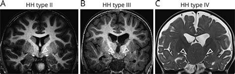 Genetic Insights Into Hypothalamic Hamartoma Neurology Genetics
