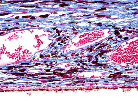Ocultaci N Coroide Mancha De Az N Foto De Archivo Imagen De Ocular Microscopia