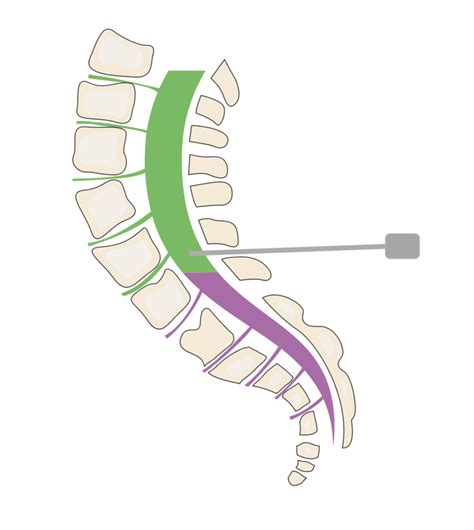 Postpunktionelles Syndrom Engl Pdph And Chronisches Pdph