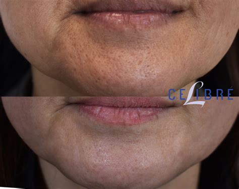 What Causes Acne Scars