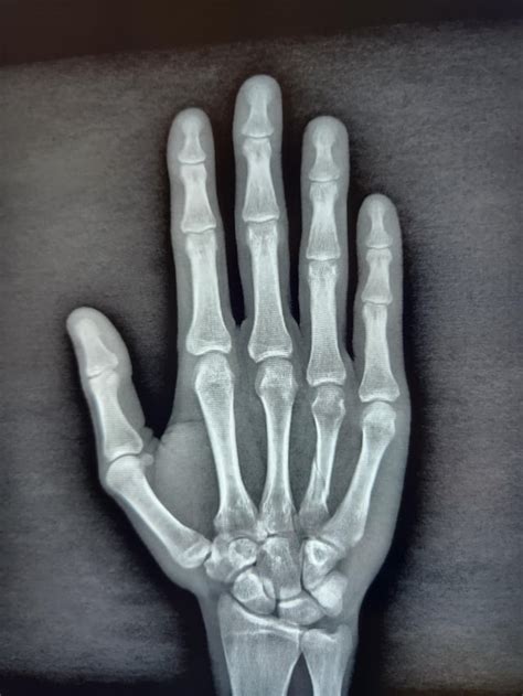Broke My 4th Metacarpal R Radiology