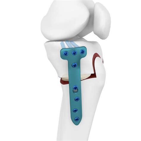 Placa Bloqueada De Osteotomía Tibial Proximal Medial Aravon Medical