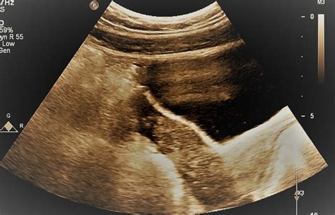 Radiopaedia Case Perforated Subhepatic Appendicitis Id 83963 Study