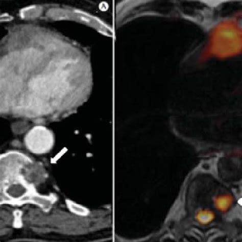 Male 71 Year Old Patient With Spinocellular Carcinoma Of The Lung On