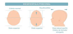 Assimetrias Cranianas Posicionais Dra Raquel Rodrigues