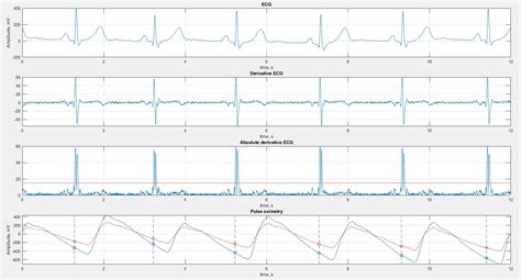 基于Matlab处理心电信号 ECG 的不同方法 索炜达 猿创