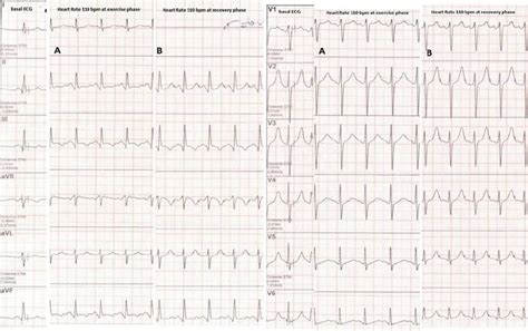 8 A Ecg Taken During The Exercise Phase Of Exercise Testing Showing A Download Scientific