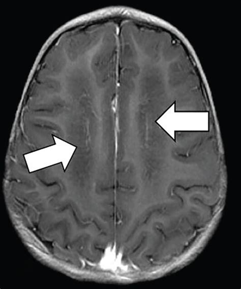 Mri Obtained 10 Days After Admission Demonstrating Mild Progression In Download Scientific