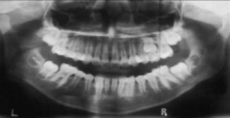 Pericoronal Radiolucency Slides Flashcards Quizlet