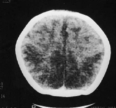 Diffuse Edema Confined To The Parietal Lobes Download Scientific Diagram