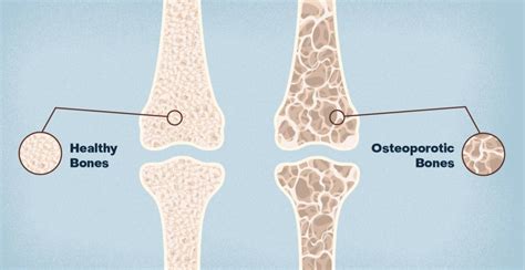 Osteoporosis Home Osteoporosis Home