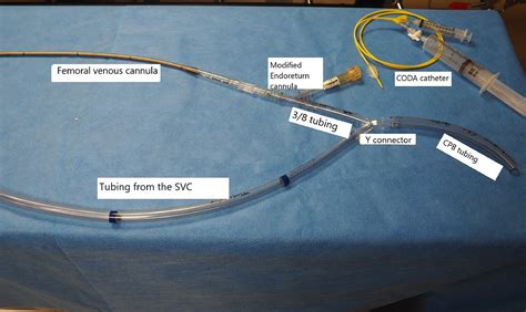 Endovascular Vena Cavae Occlusion Technique In Minimally Invasive