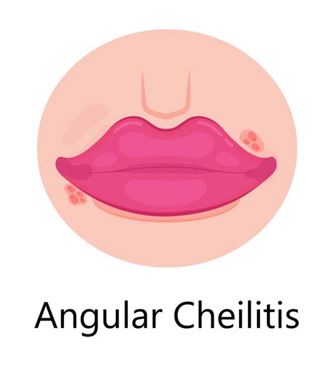 Cheilitis Lips Symptoms Causes And Effective Treatments