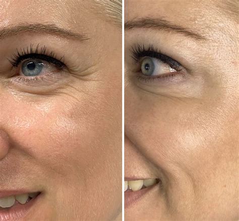 Everything You Should Know About Crows Feet Eye Treatment Isaac Luxe
