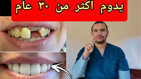 اقوي نوع تركيب اسنان يدوم اكثر من ٣٠ عام Youtube