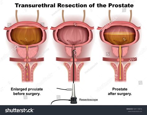 Transurethral Resection 3d Illustration Medical Vector Stock Vector