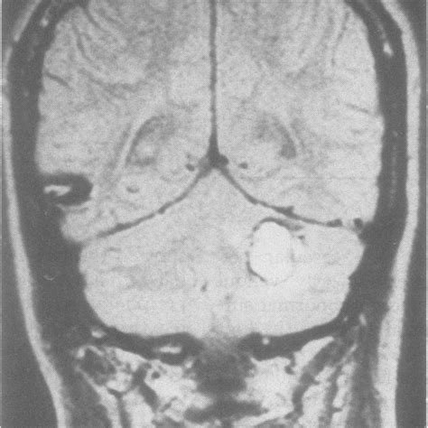 Coronal Mri T2 Te1 Of A Patient With Multiple Cavernomas Left