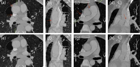 Motion Correction For Routine X Ray Lung Ct Imaging