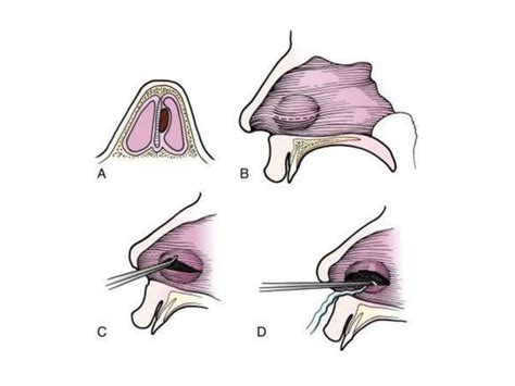 Clinical Procedures Septalauricular Hematoma Pptx Death Injury