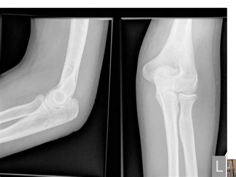 Proximal Ulna Fractures Pdf