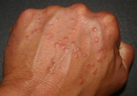 Squamous Cell Carcinoma 10 Squamous Cell Carcinoma Symptoms