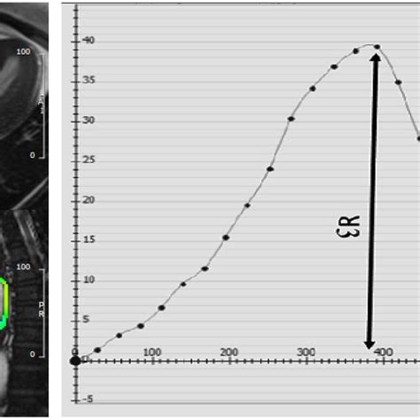 Left Atrial Strain Measurement Using Cardiac Mri Feature Tracking A