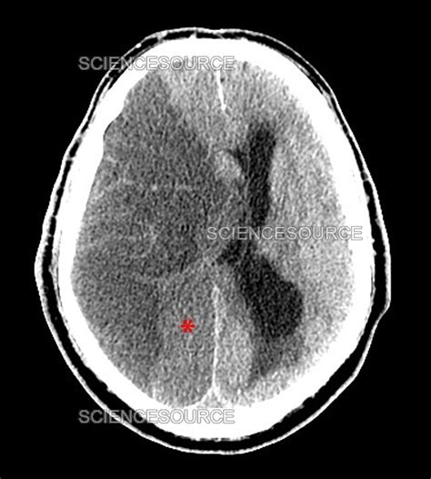 Large Stroke Ct Scan Stock Image Science Source Images