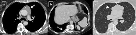 Ct Is The Imaging Modality Of Choice For Evaluating Staging Thymoma Download Scientific