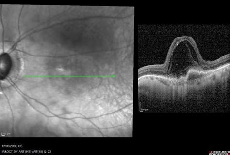 Bacillary Layer Detachment In Retina Eyewiki