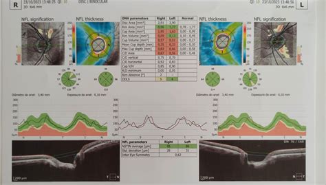 Please Help Me How Are My Oct And Visual Field Exams Is It Possible