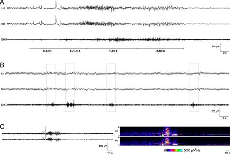 Eegemg Recordings And Spectrogram Analysis Of A Typical Spontaneous