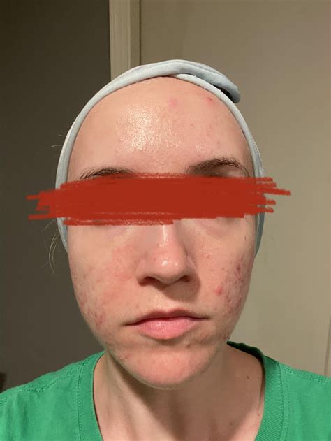 Plz Tell Me What Is Happening To My Skin Rtretinoin