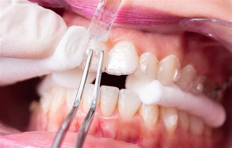 Protocolo Pir ¿cuándo Y Cómo Usarlo