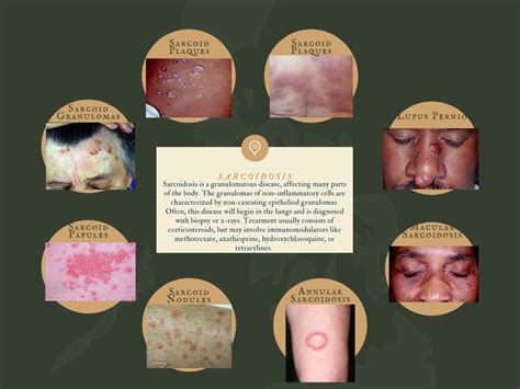Lupus Pernio Sarcoidosis