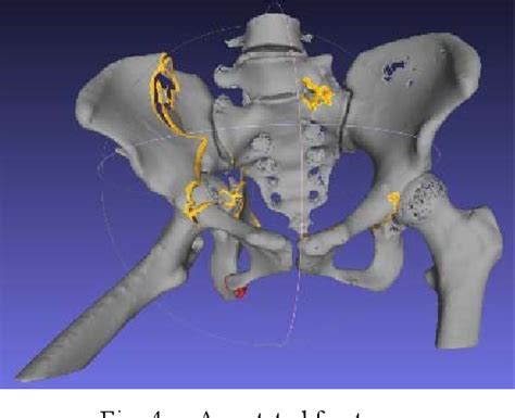 Figure 4 From An Automated Fracture Detection From Pelvic Ct Images