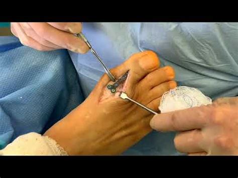 First Metatarsal Phalangeal Joint Mtp Fusion With Plate Youtube